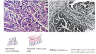 endometrial carcinoma obstetrics and gynecology | PDF