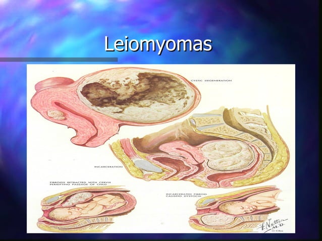 Obgyn Gyn Problems Ii | PPT