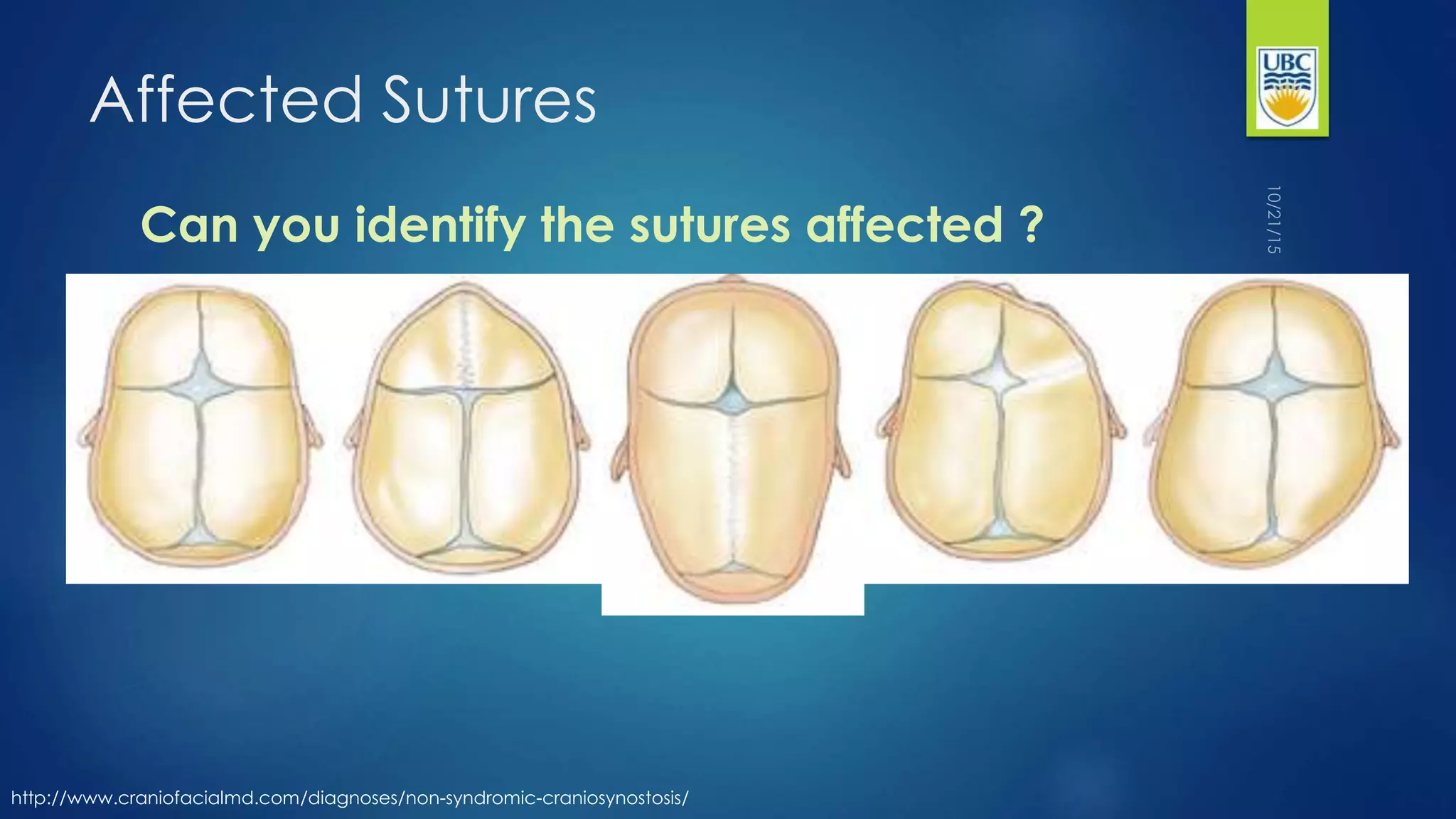 Sutures of the Skull | PPTX