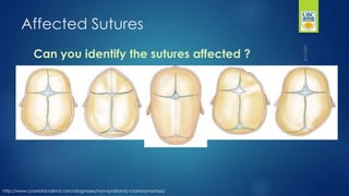 Sutures of the Skull | PPTX