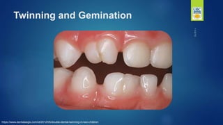 Supernumerary Teeth | PPTX