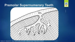 Supernumerary Teeth | PPTX