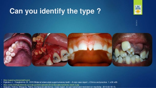 Supernumerary Teeth