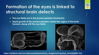 Holoprosencephaly | PPTX
