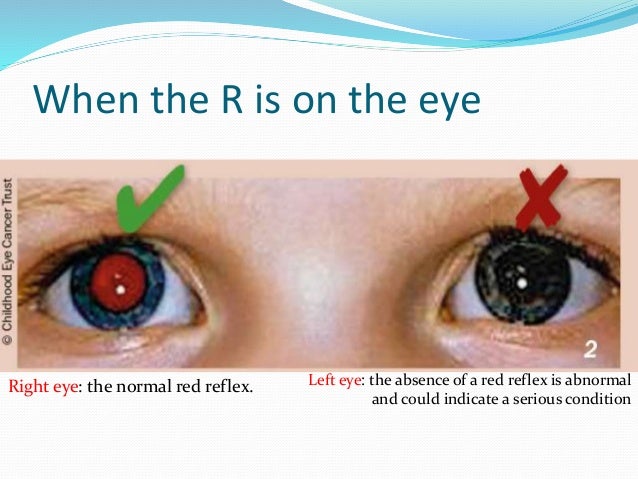 Objective refraction