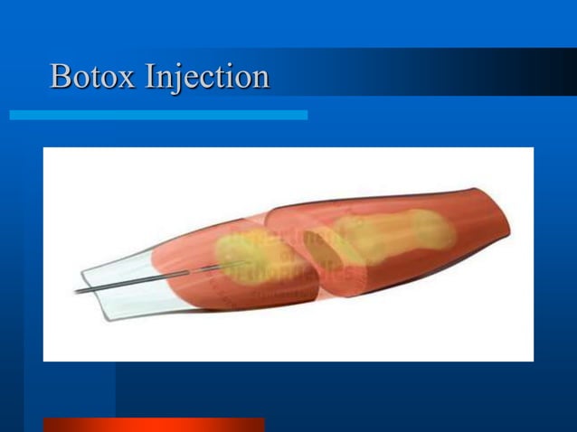 Obstetric Brachial Plexus Palsy | PPT | Pregnancy | Reproductive Health