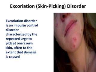 Obsessive compulsive disorder | PPT