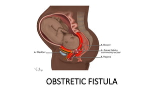OBS Fistula obstetrics and gynecology ppt | PPTX