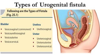 OBS Fistula obstetrics and gynecology ppt | PPTX