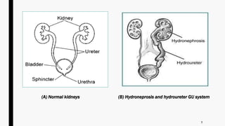 Minor Ailments During Pregnancy: Genitourinary system changes | PPTX