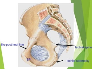Ischial Spine