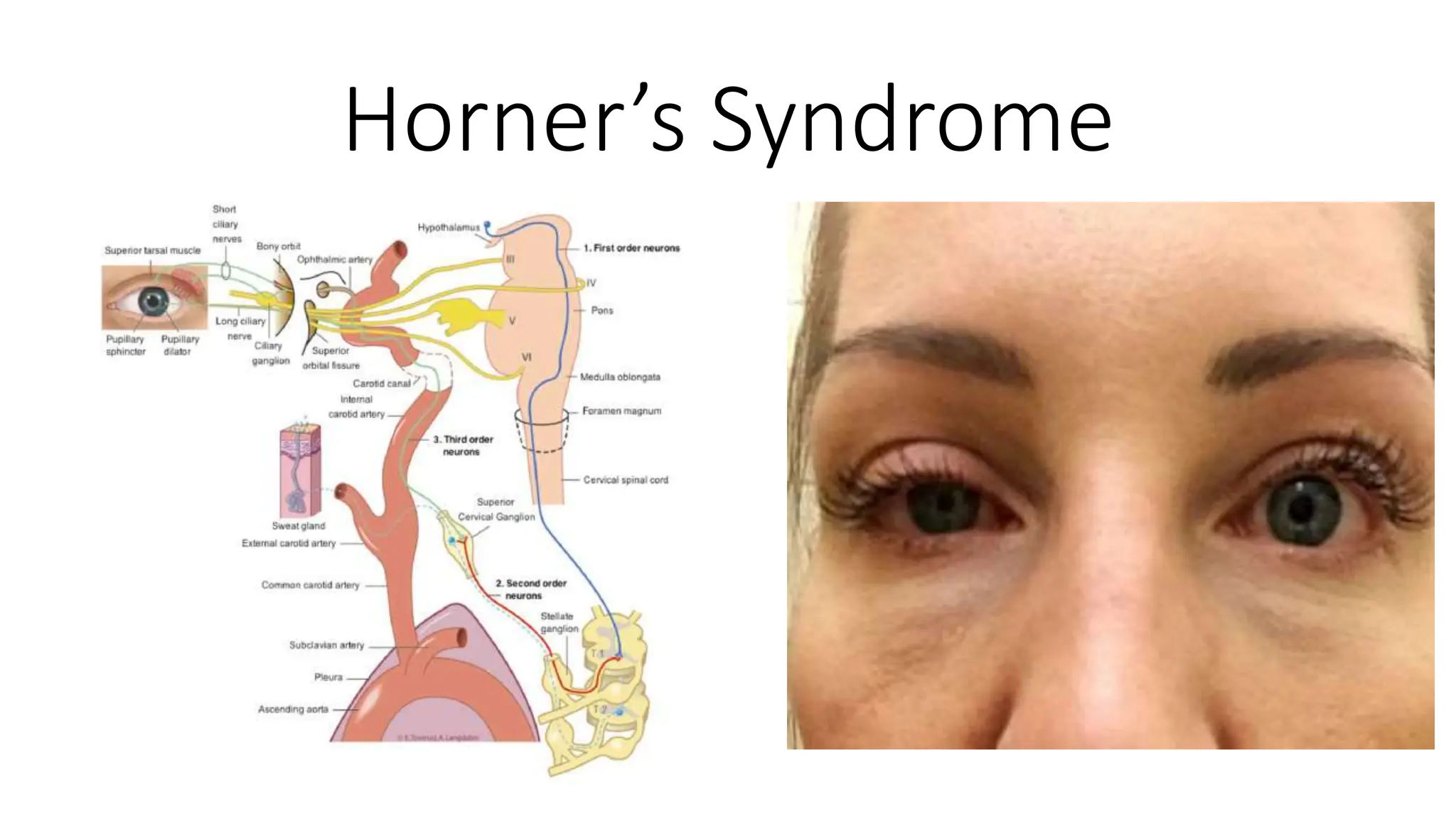 Obstetrical Brachial Plexus Palsy(OBPI).pptx