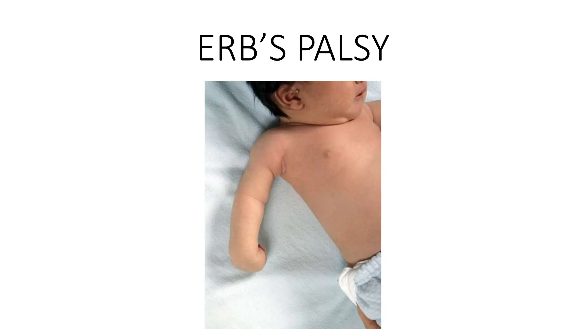 Obstetrical Brachial Plexus Palsy(OBPI).pptx
