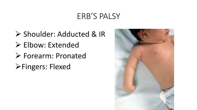 Obstetrical Brachial Plexus Palsy(OBPI).pptx