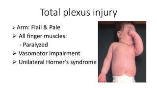 Obstetrical Brachial Plexus Palsy(OBPI).pptx