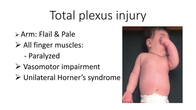 Obstetrical Brachial Plexus Palsy(OBPI).pptx