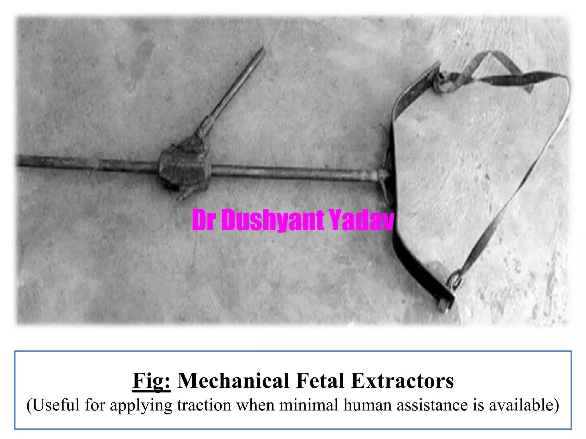 Obstetrical operation in Bovine By Dr Dushyant Yadav, Bihar Animal ...