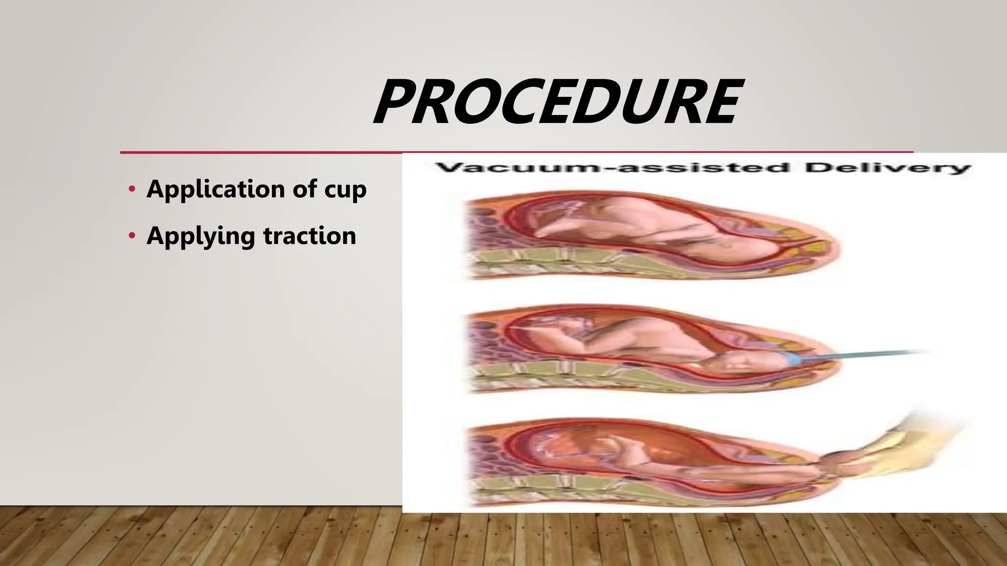 OBSTETRICAL OPERATIONS & PROCEDURES.pptx