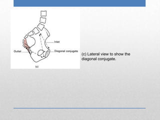 Obstetrical pelvic measurements | PPTX