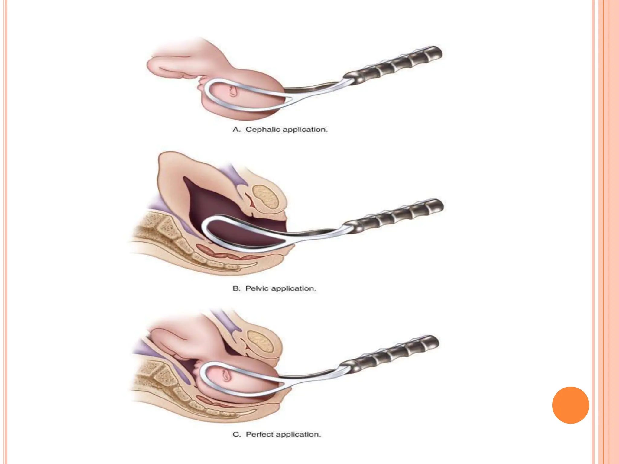 OBSTETRICAL PROCEDURES AND OPERATIONS.pptx