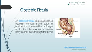 Obstetric Fistula: Causes, Symptoms and Treatment | PPTX