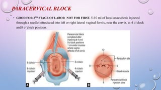 OBSTETRICIAN’s PERSPECTIVE OF LABOUR ANALGESIA.pptx