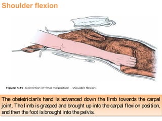 Obstetric manoeuvres | PPT