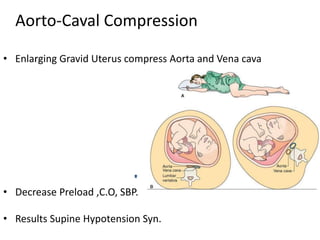 Obstetrics anaesthesia | PPTX