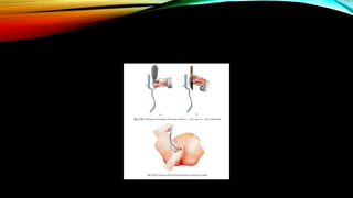 OBSTETRICS FORCEPS на портал.pptx