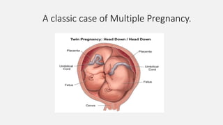 Multiple Pregnancy-Obstetrics presentation. | PPTX