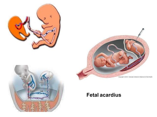 Multiple pregnancy | PPTX