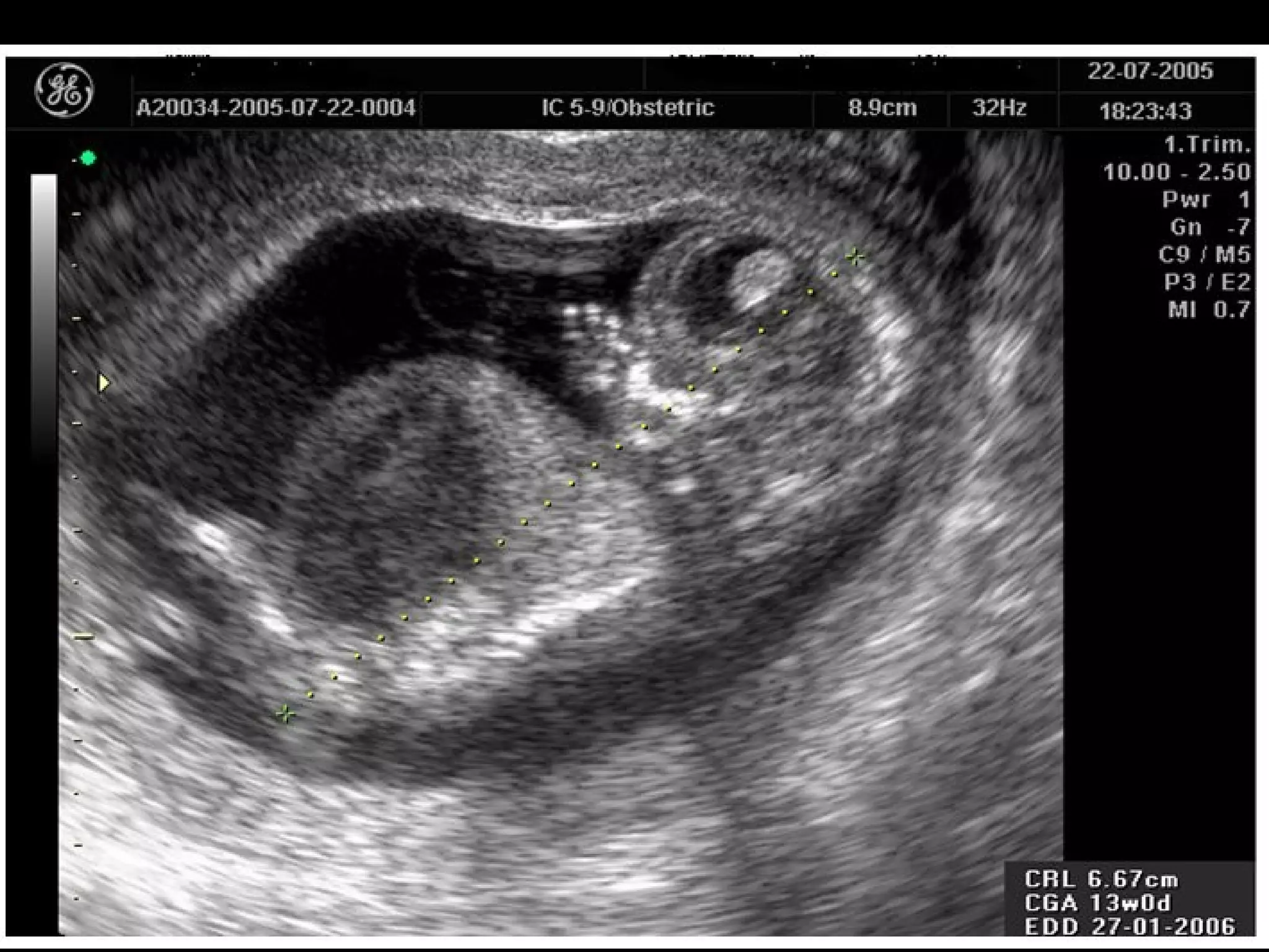 Obstetric ultrasound | PPT