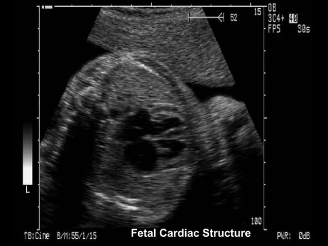 Obstetric ultrasound | PPT