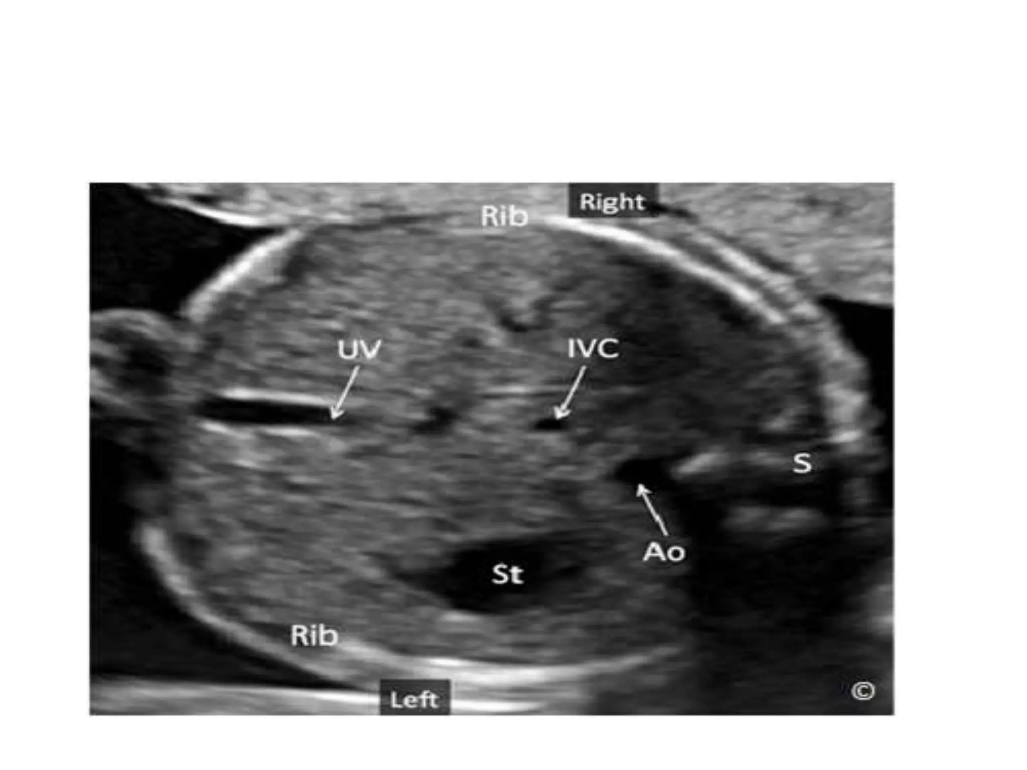 Obstetric ultrasound - Radiology | PPTX