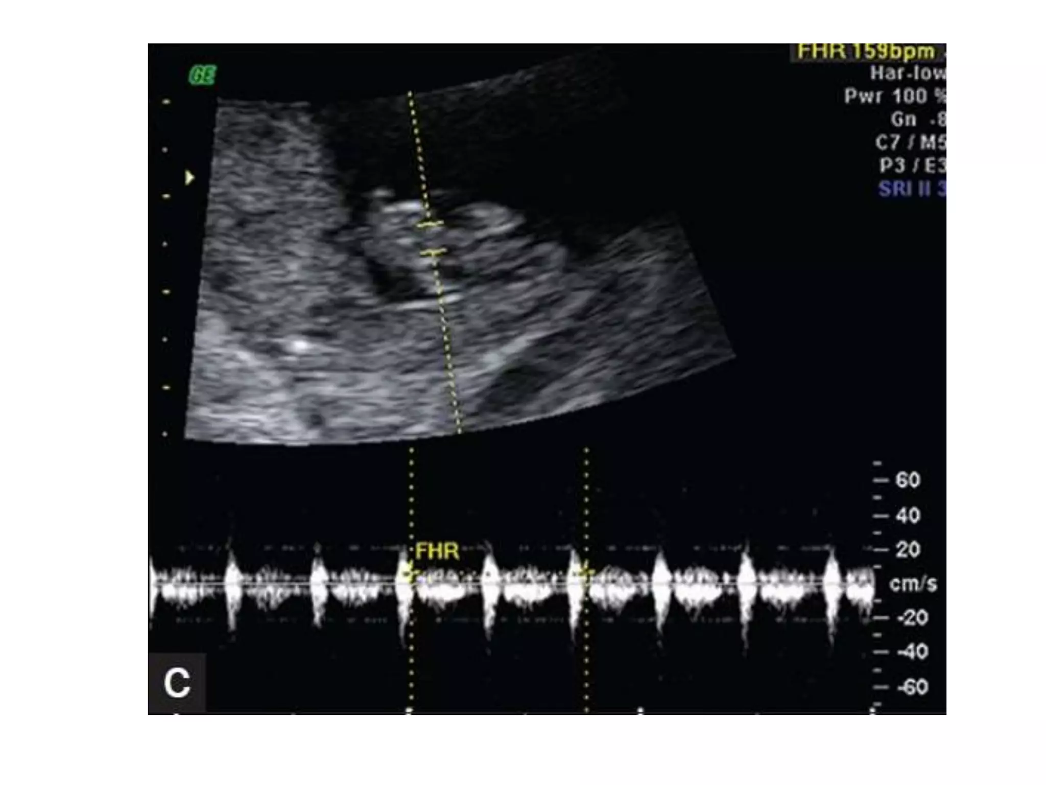 obstetric ultrasound.ppt