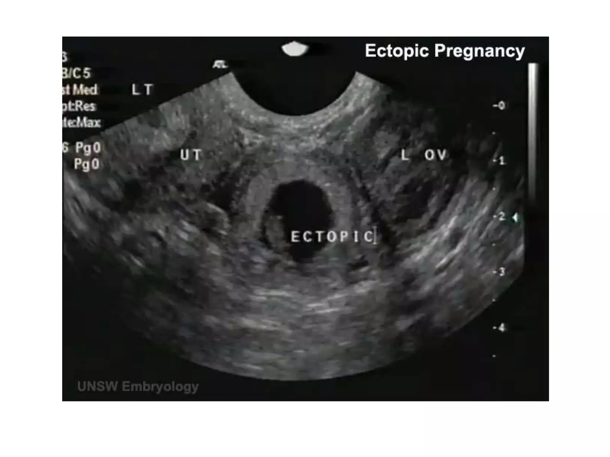obstetric ultrasound.ppt