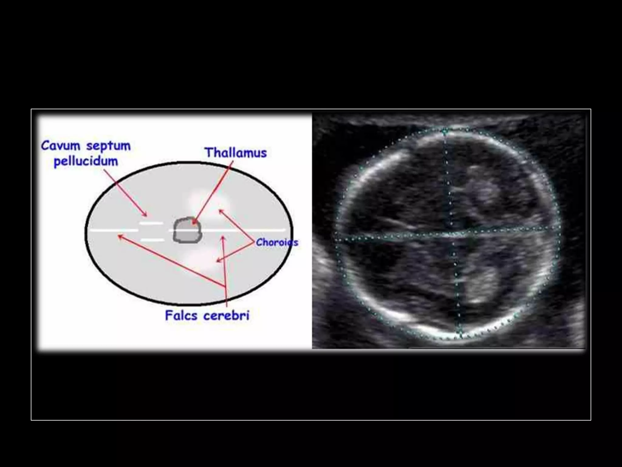 Obstetric Ultrasound -Lecture 09 -Fetal growth.pdf
