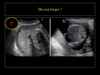 Obstetric Ultrasound -Lecture 09 -Fetal growth.pdf