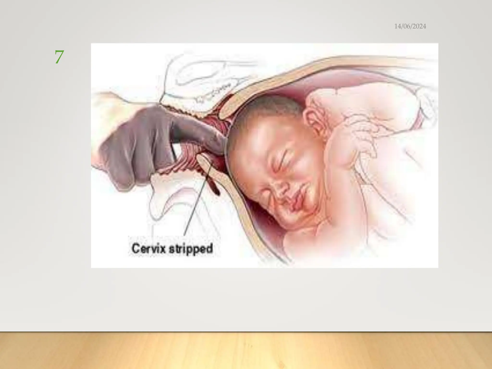 PPT Edukasi Obstetri induksi Persalinan.pptx