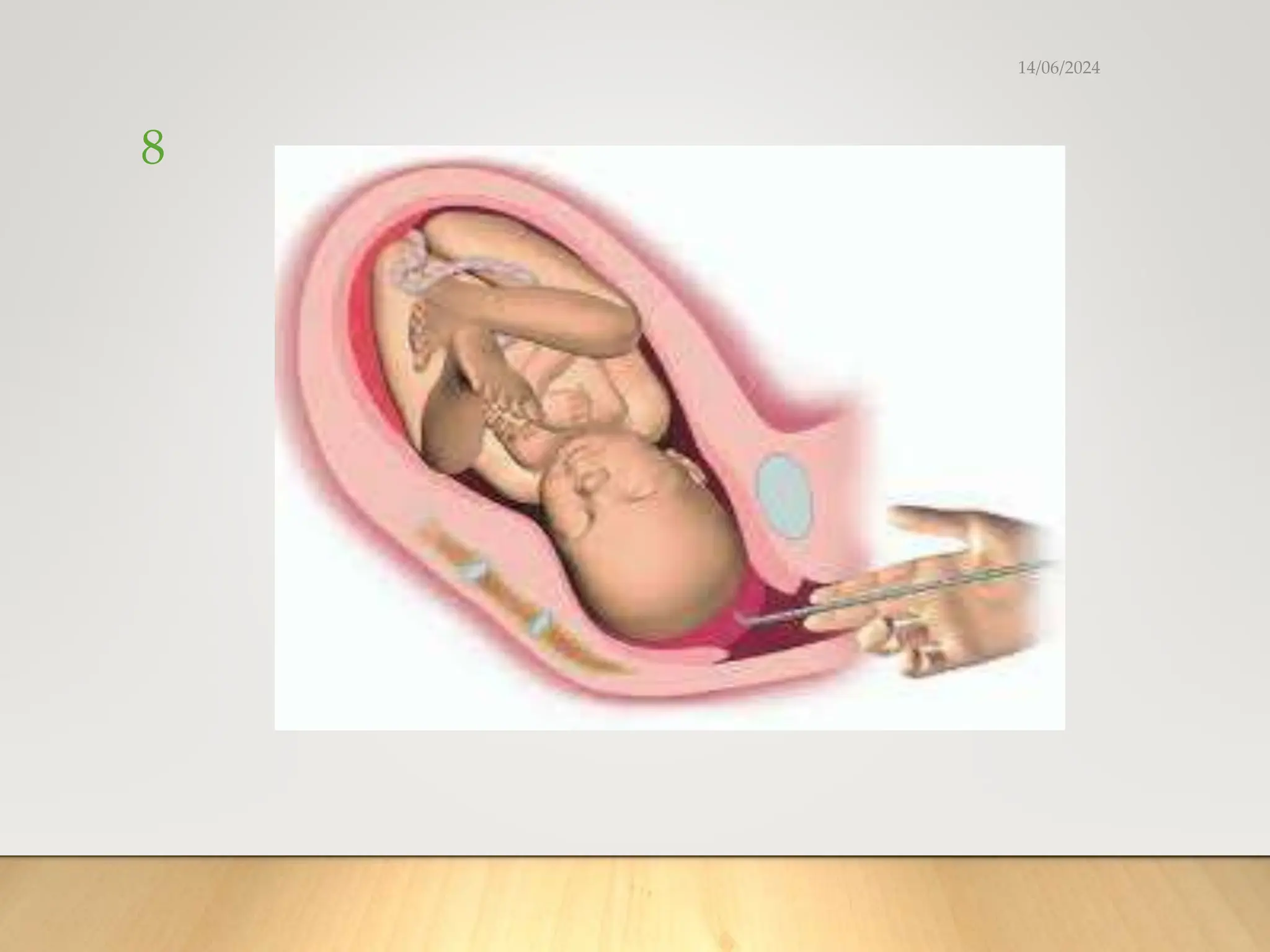 PPT Edukasi Obstetri induksi Persalinan.pptx