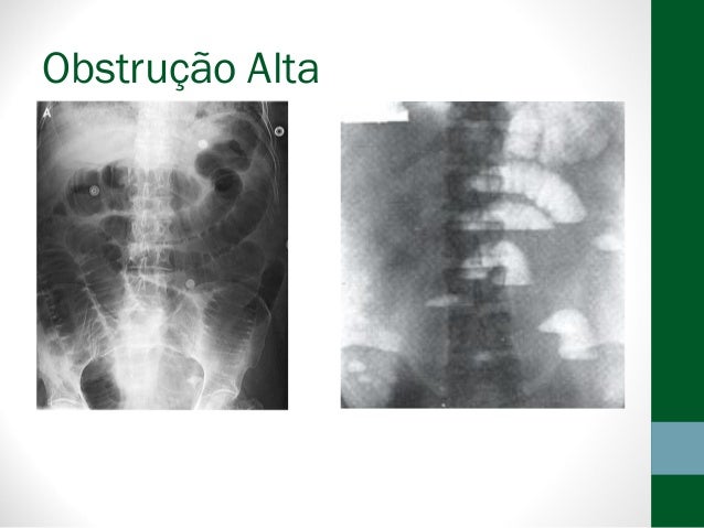Obstrucao intestinal aula