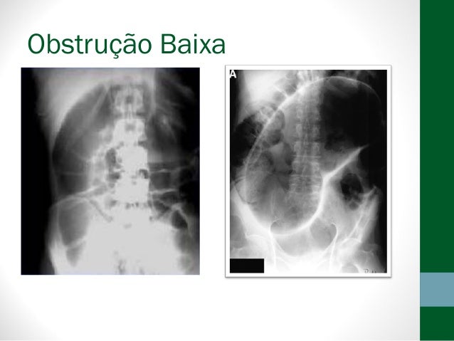Obstrucao intestinal aula