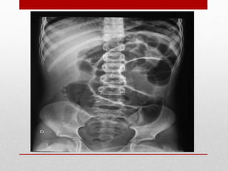 Obstrucción intestinal | PPTX