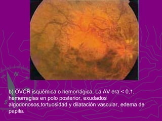 ObstruccióN De La Vena Central De La Retina | PPT