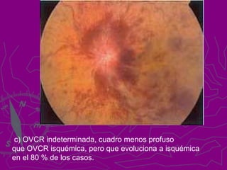 ObstruccióN De La Vena Central De La Retina | PPT