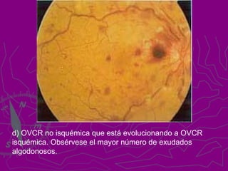 ObstruccióN De La Vena Central De La Retina | PPT