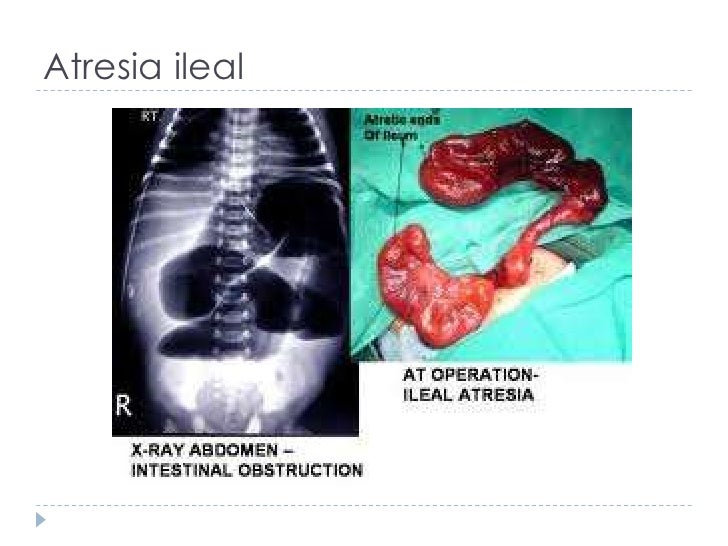 Obstrucción intestinal