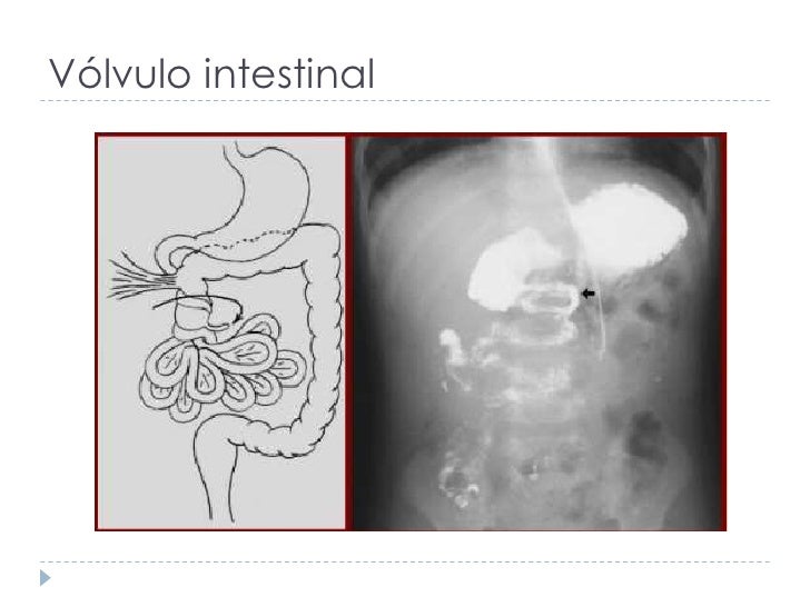 Obstrucción intestinal