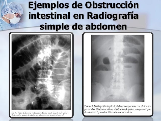 Obstrucción Intestinal