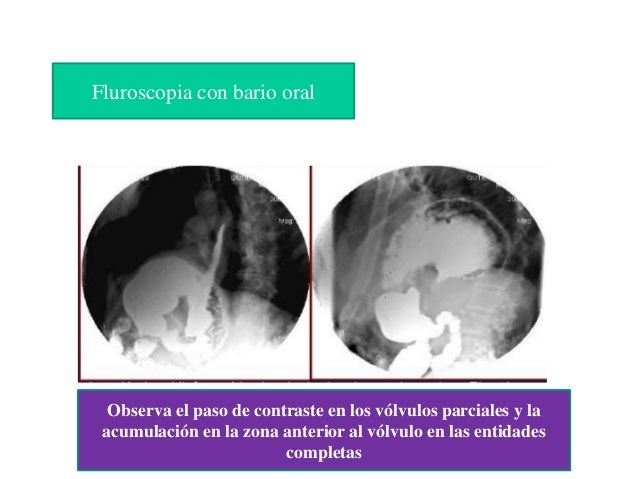 Que Es Estomago Distendido - encuentros de sexo